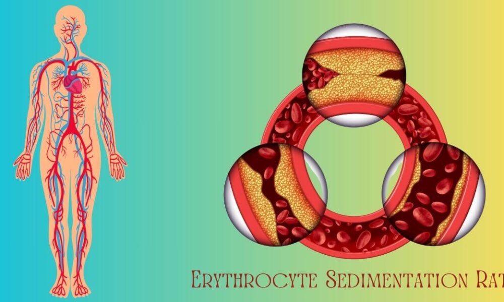 10 Best Home Remedies To Reduce ESR In Blood (Full Review)